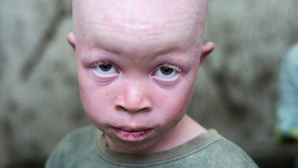 End violence against people with albinism: Towards effective criminal ...